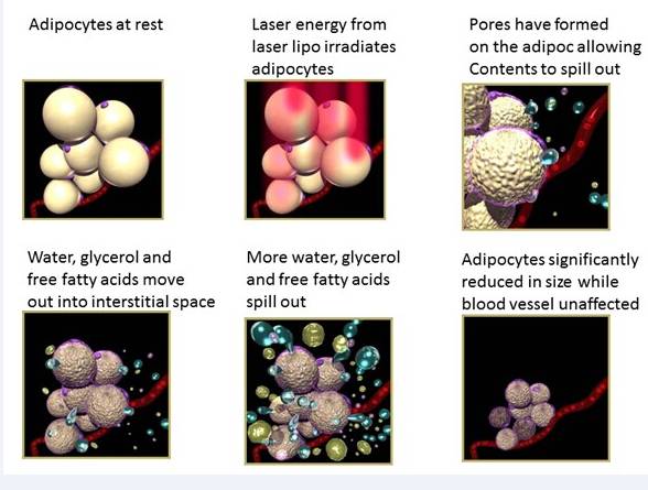 Νεώτερη μηχανή αδυνατίσματος Lipolaser με τις διόδους της Mitsubishi εισαγωγών για τη μείωση του λίπους