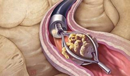 Cesta de piedra endoscópica disponible de la recuperación para la eliminación del cuerpo extraño