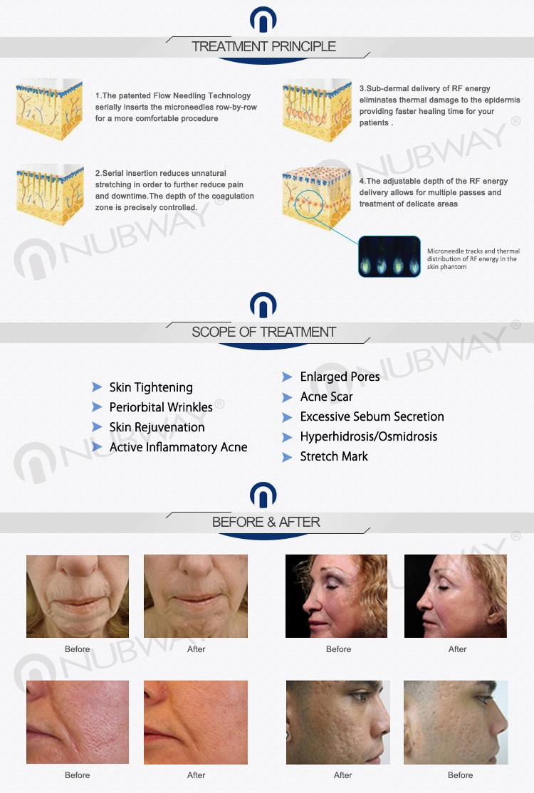 La stazione termale di vendita più calda utilizza la macchina frazionaria del microneedle di rf per ringiovanimento della pelle