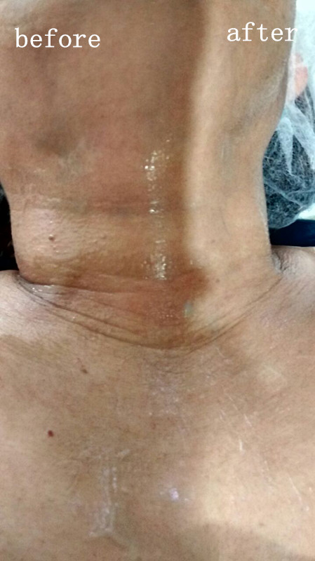Descasque o levantamento da queixada da máquina da remoção do enrugamento da cara da máquina do rejuvenescimento