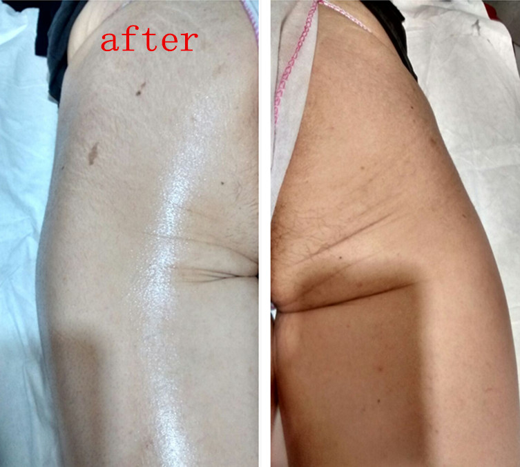 Descasque o levantamento da queixada da máquina da remoção do enrugamento da cara da máquina do rejuvenescimento
