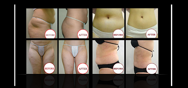 Potente!!!macchina di congelamento grassa della liposuzione di cavitazione cryolipolysis a macchina/ultrasonico di cryolipolysis da vendere