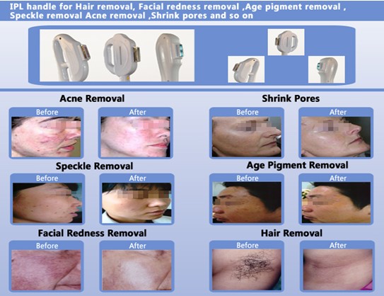 Chargement initial sûr portatif rf, dispositif d'E-lumière de beauté d'Epilation de rajeunissement de peau de levage de visage