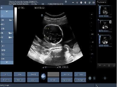Sonda cardiaca lineare convessa di ultrasuono della sonda della sonda senza fili transvaginale di ultrasuono staccabile