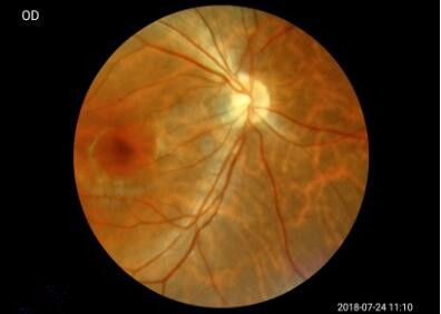 Система андроида для камеры Fundus более легкой деятельности ручной с минимальным разрешением изображения 1920x1080 зрачка 2.5mm