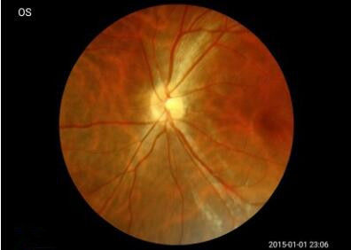 Система андроида для камеры Fundus более легкой деятельности ручной с минимальным разрешением изображения 1920x1080 зрачка 2.5mm