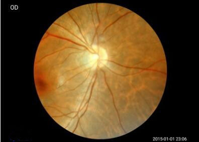 Система андроида для камеры Fundus более легкой деятельности ручной с минимальным разрешением изображения 1920x1080 зрачка 2.5mm