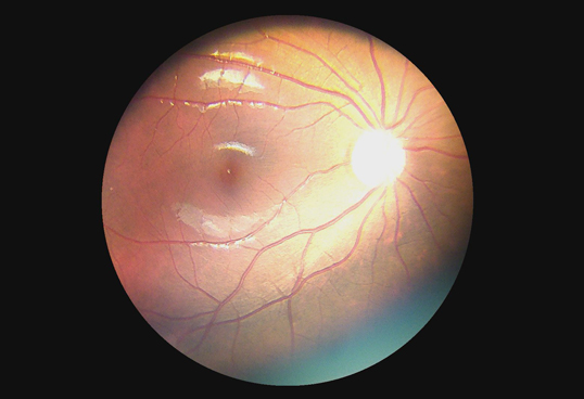 40° разрешения 2560 x 1920 пикселов цифров Fundus камера Fundus ручного фокуса камеры портативная