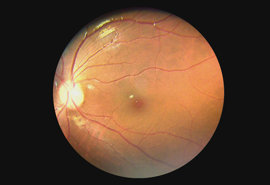 40° разрешения 2560 x 1920 пикселов цифров Fundus камера Fundus ручного фокуса камеры портативная